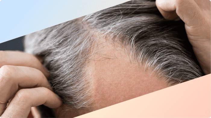 Why do I pick at my scalp? | NOCD