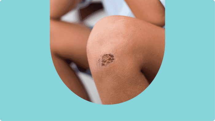 Why Do I Pick My Scabs? Understanding and Stopping Skin-Picking | NOCD